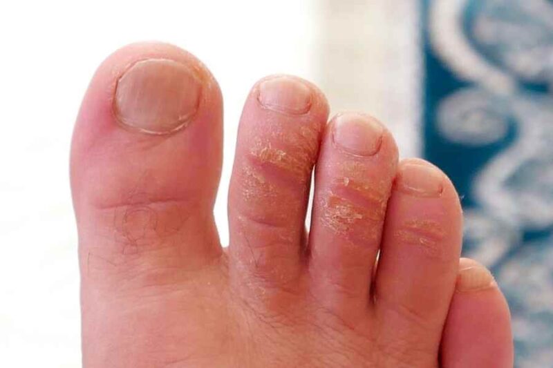 Tipos y tratamientos de los callos en los dedos de los pies